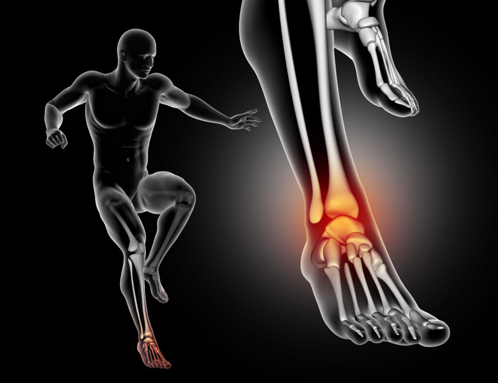 Foot & Ankle Ligament Injury Treatment Without Surgery